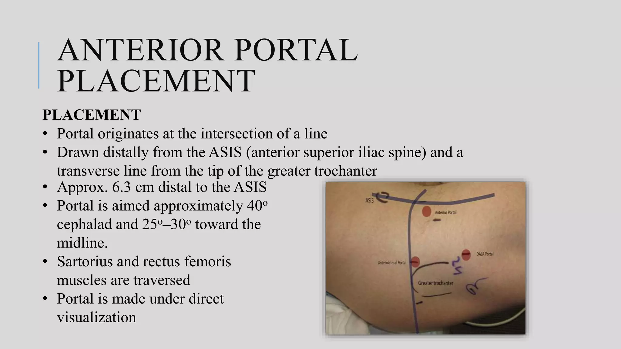 Hip Arthroscopy Pptx