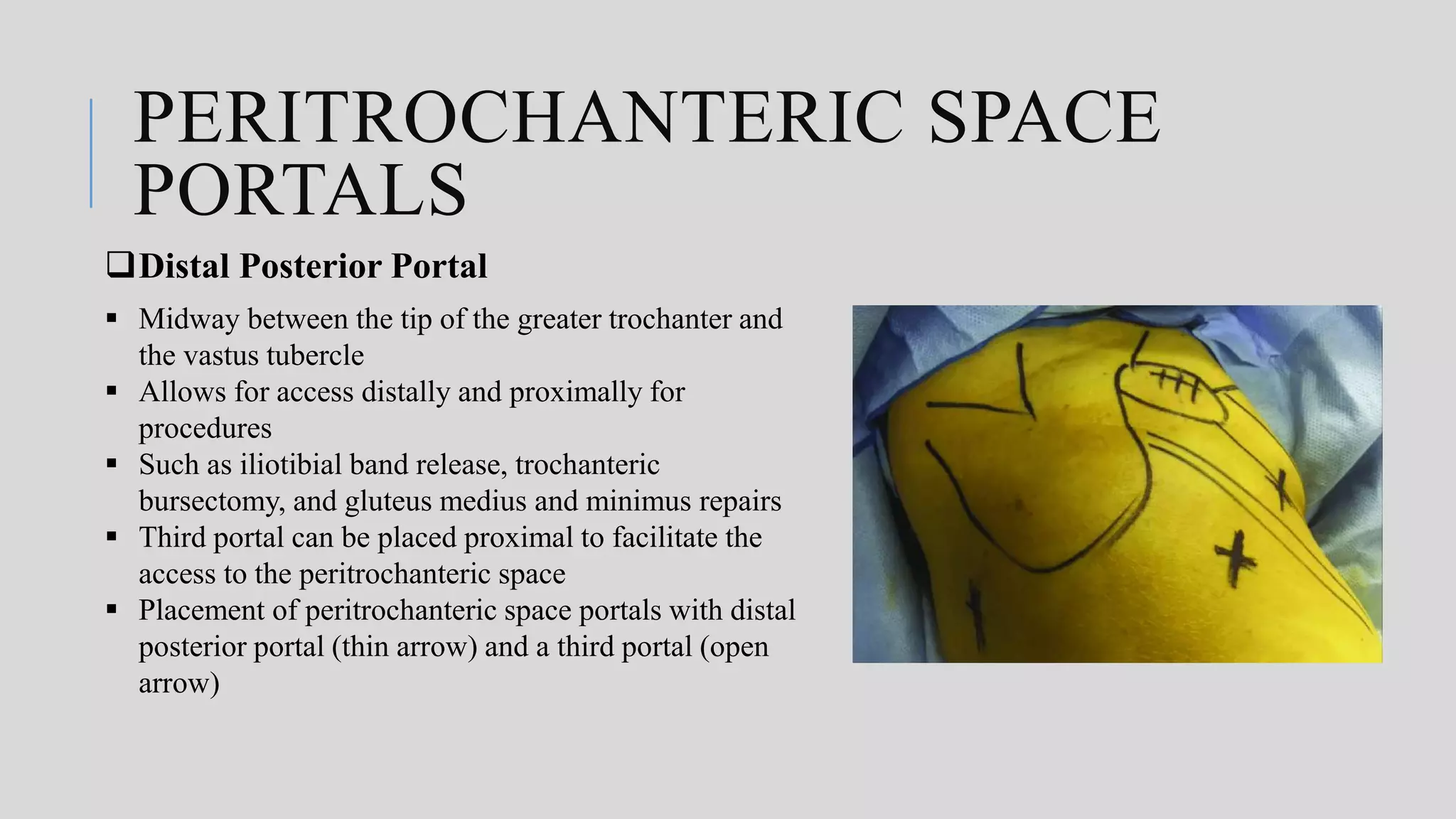 Hip Arthroscopy | PPTX