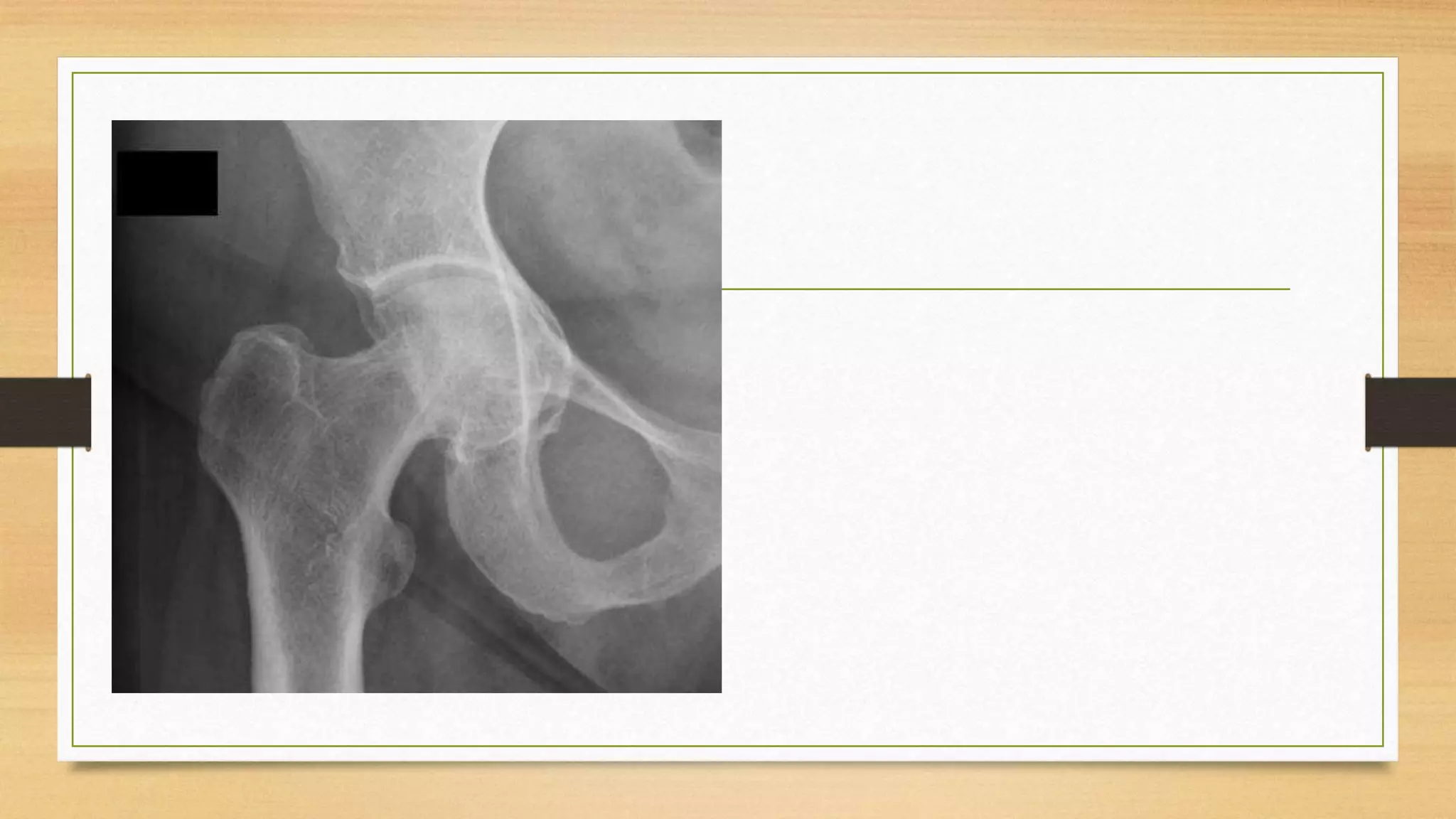 Hip complex Biomechanics | PPTX