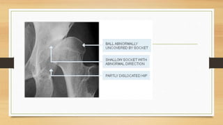 Hip complex Biomechanics | PPTX