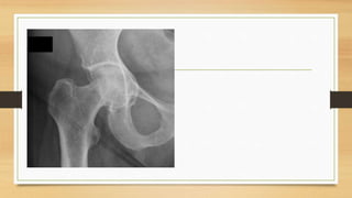 Hip complex Biomechanics | PPTX