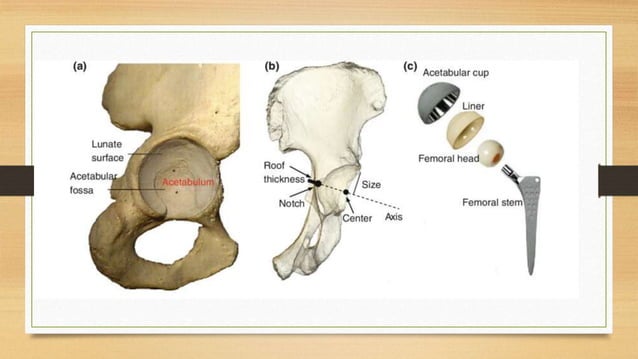 Hip complex Biomechanics | PPTX
