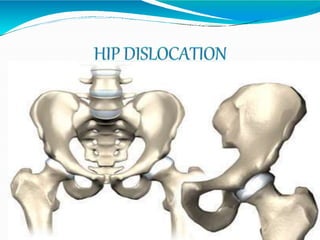 HIP DILOCATION.pptx