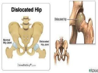 HIP DILOCATION.pptx