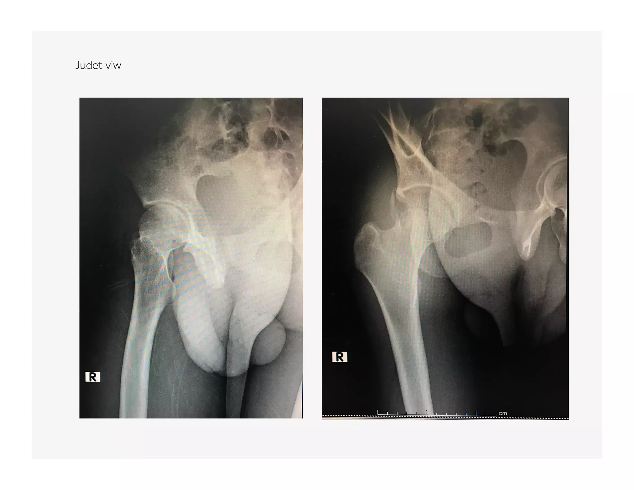 posterior hip dislocation | PDF