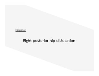 posterior hip dislocation | PDF