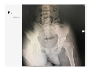 posterior hip dislocation | PDF