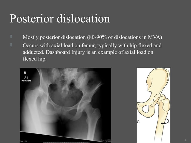 Hip dislocation | PPT