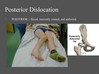 Hip dislocation | PPT
