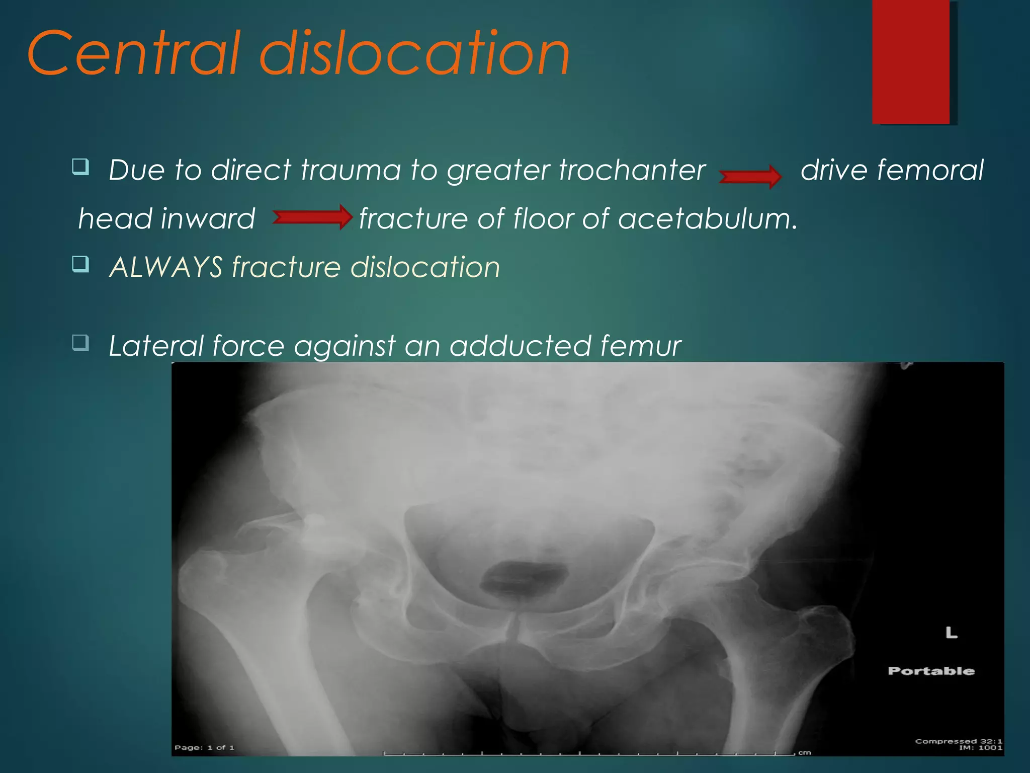 Hip dislocation | PPT