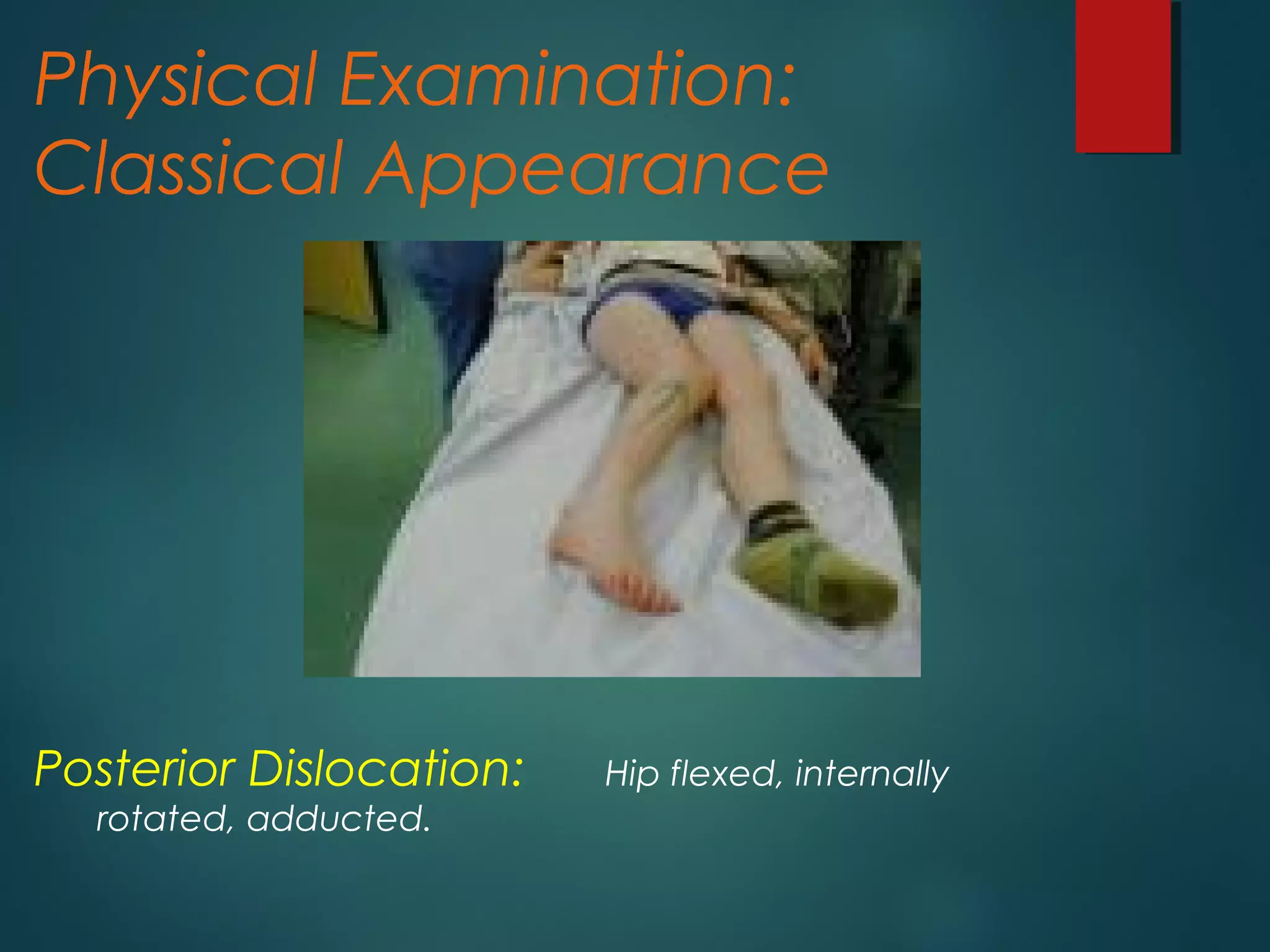 Hip dislocation | PPT