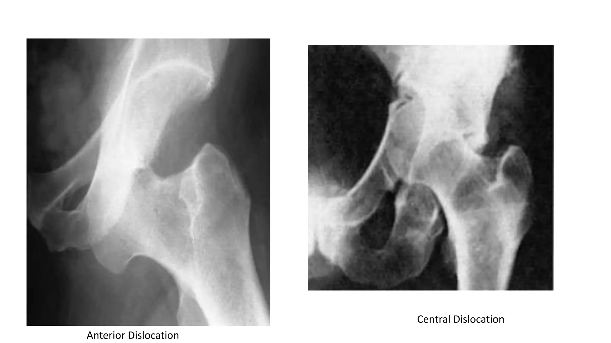 Hip dislocation | PPTX