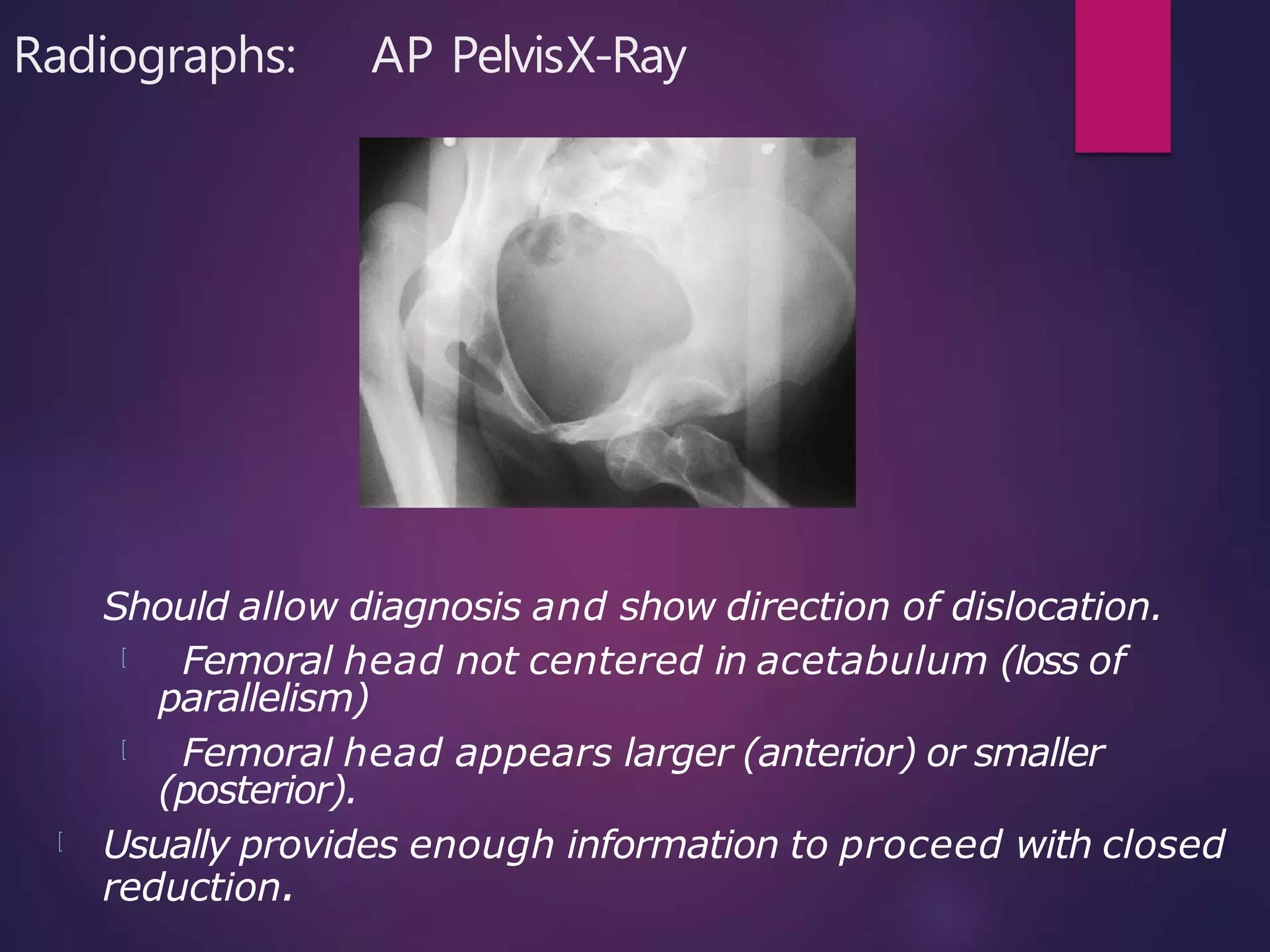Hip dislocation | PPT