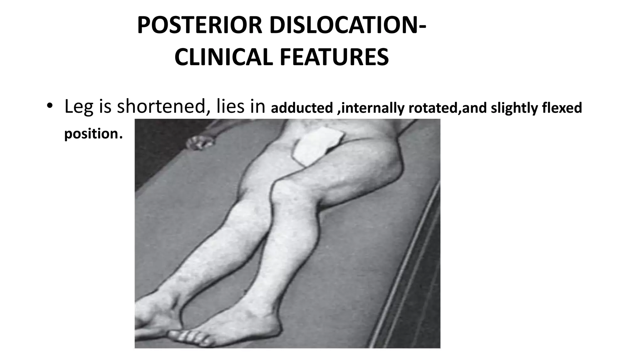Hip dislocation | PPTX