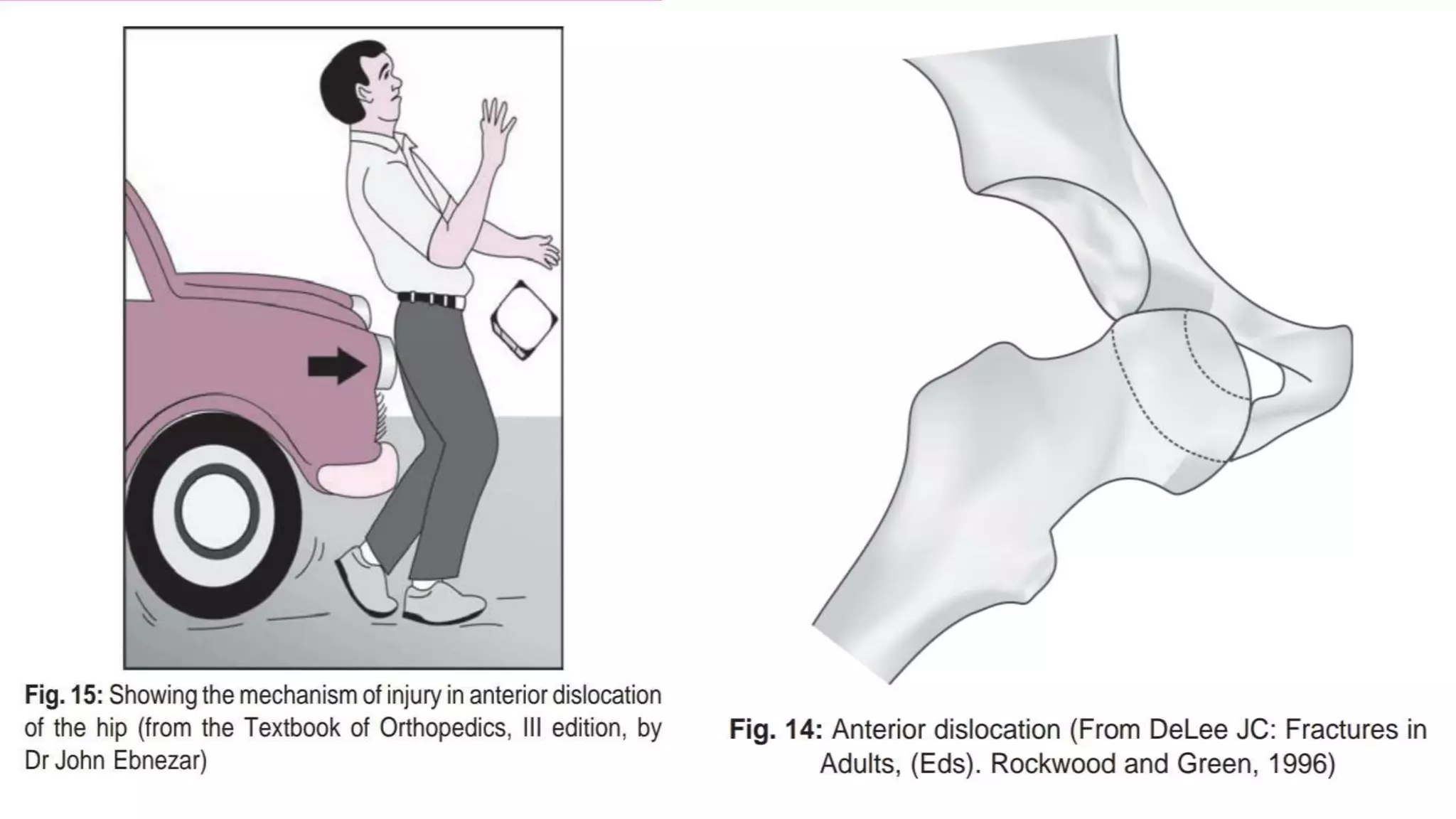 Hip dislocation | PPTX