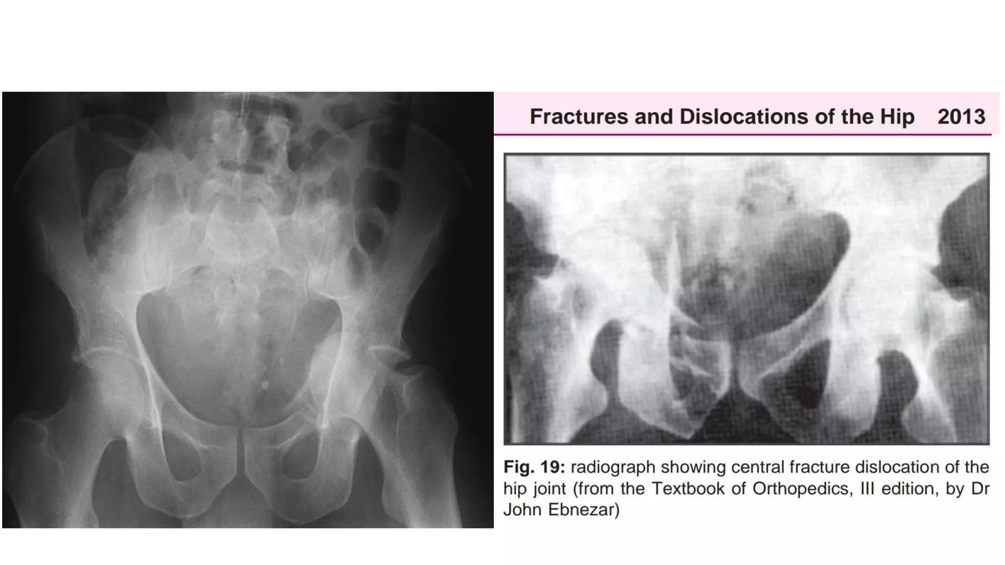 Hip dislocation | PPTX