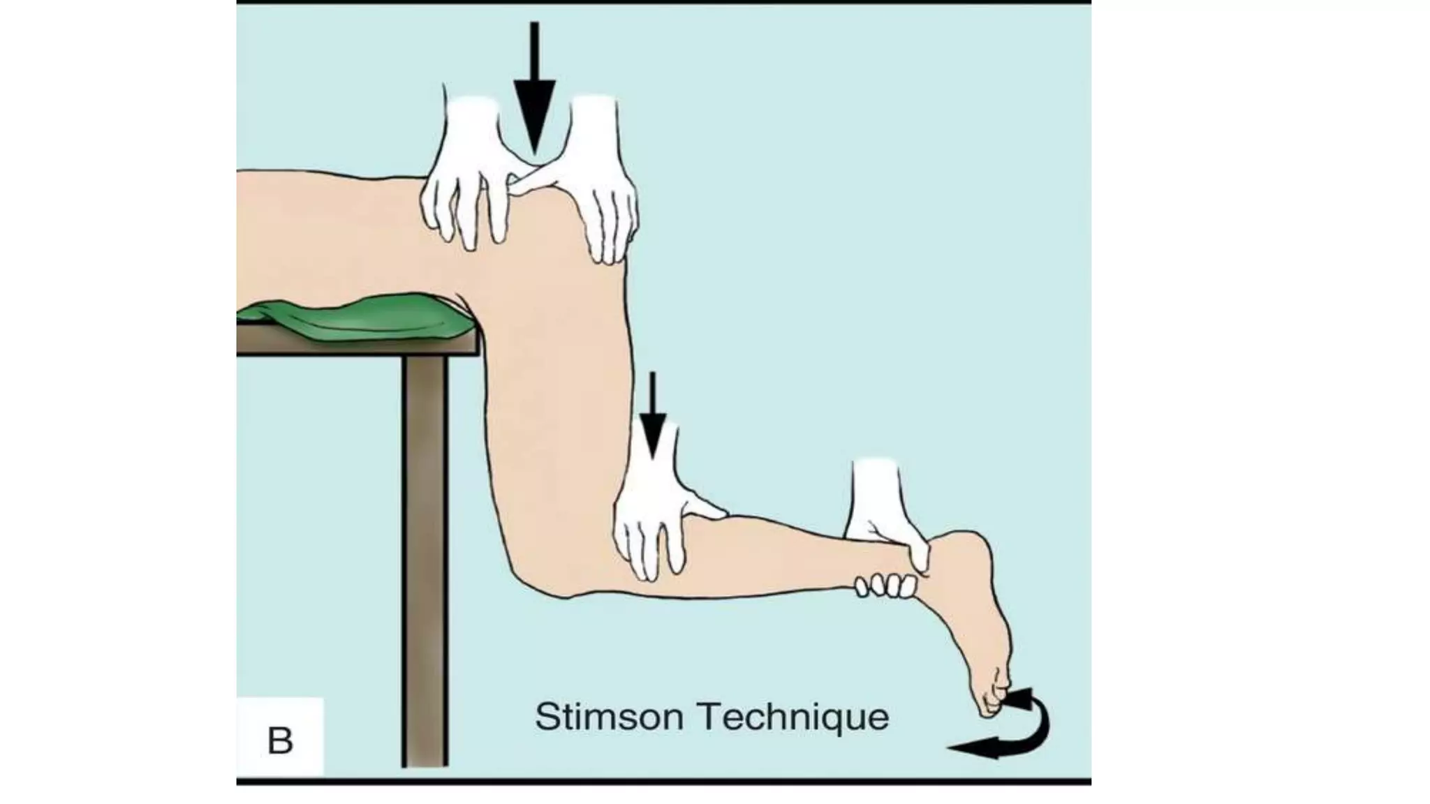 Hip dislocation | PPTX
