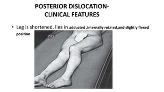 Hip dislocation | PPTX