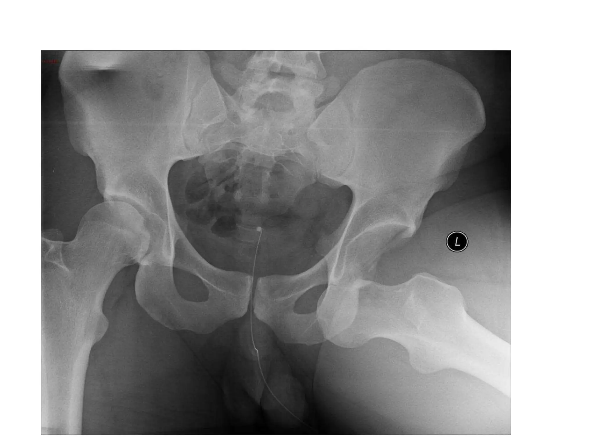 Hip Dislocation.pptx. . | PPTX