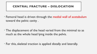 hipdislocation- final.pptxkkkjhhgfddsssgjk | PPTX