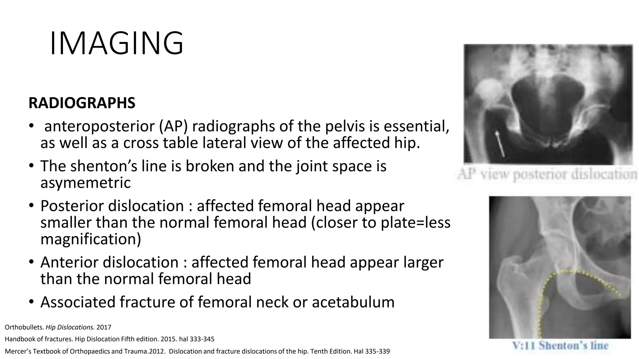 hip dislocation, anatomy, history, diagnosis, treatment and management.pptx