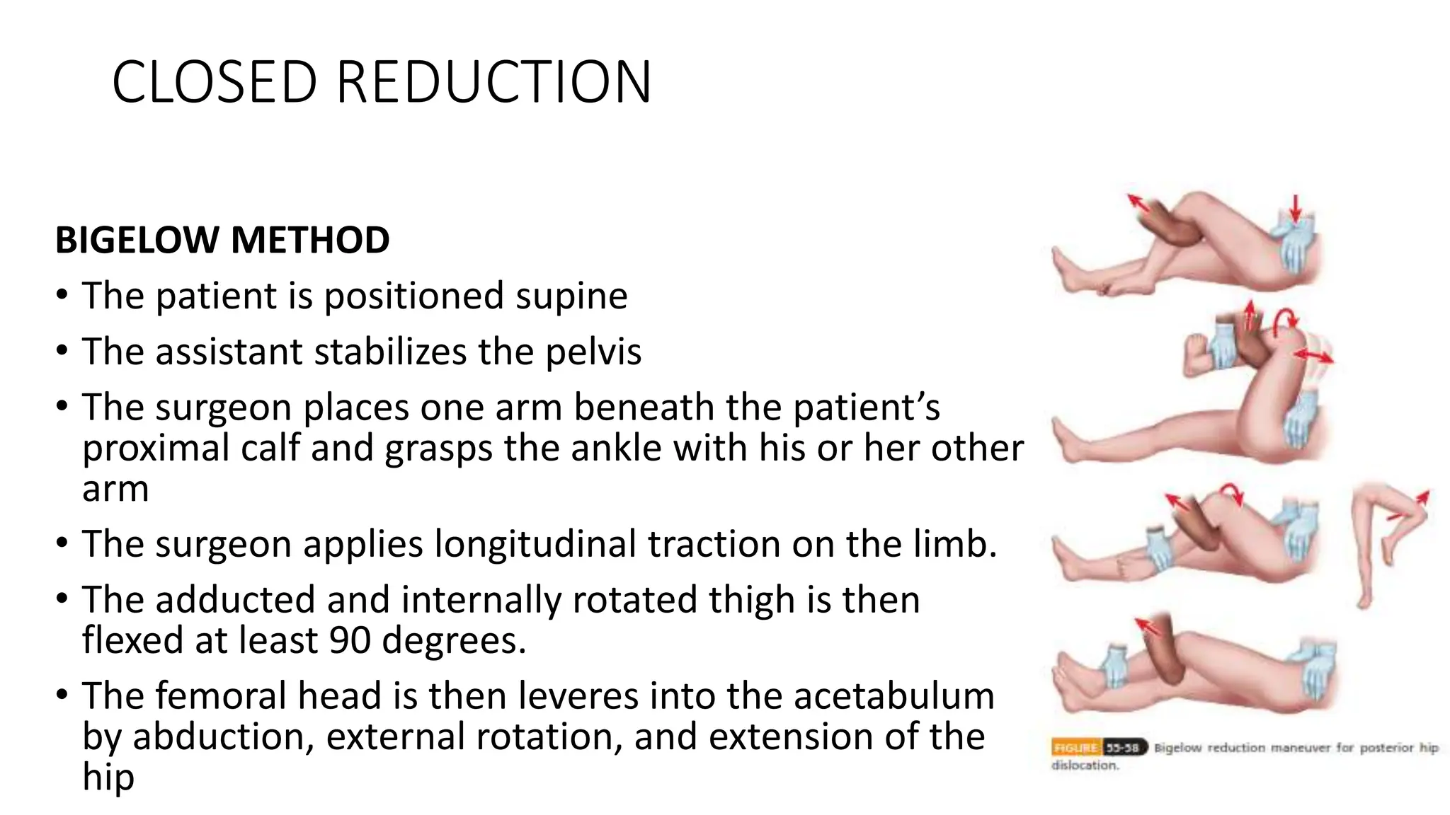 hip dislocation, anatomy, history, diagnosis, treatment and management.pptx