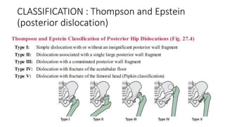 hip dislocation, anatomy, history, diagnosis, treatment and management.pptx