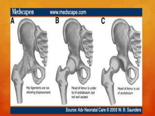 Hip dislocation ppt | PPT