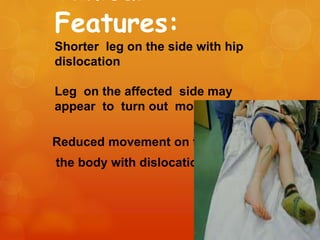 Hip dislocation ppt | PPT