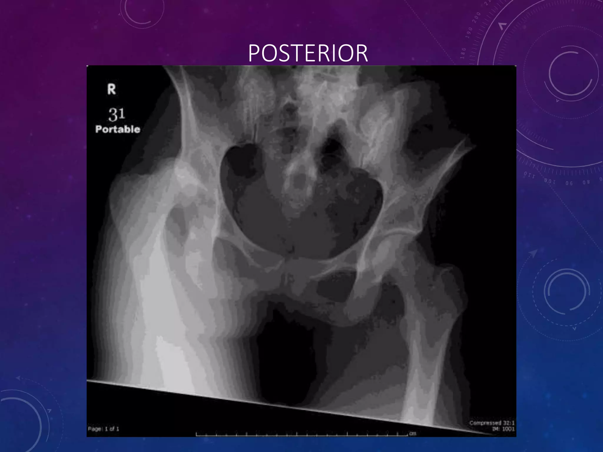 Hip Dislocation PPT FINAL.pptx