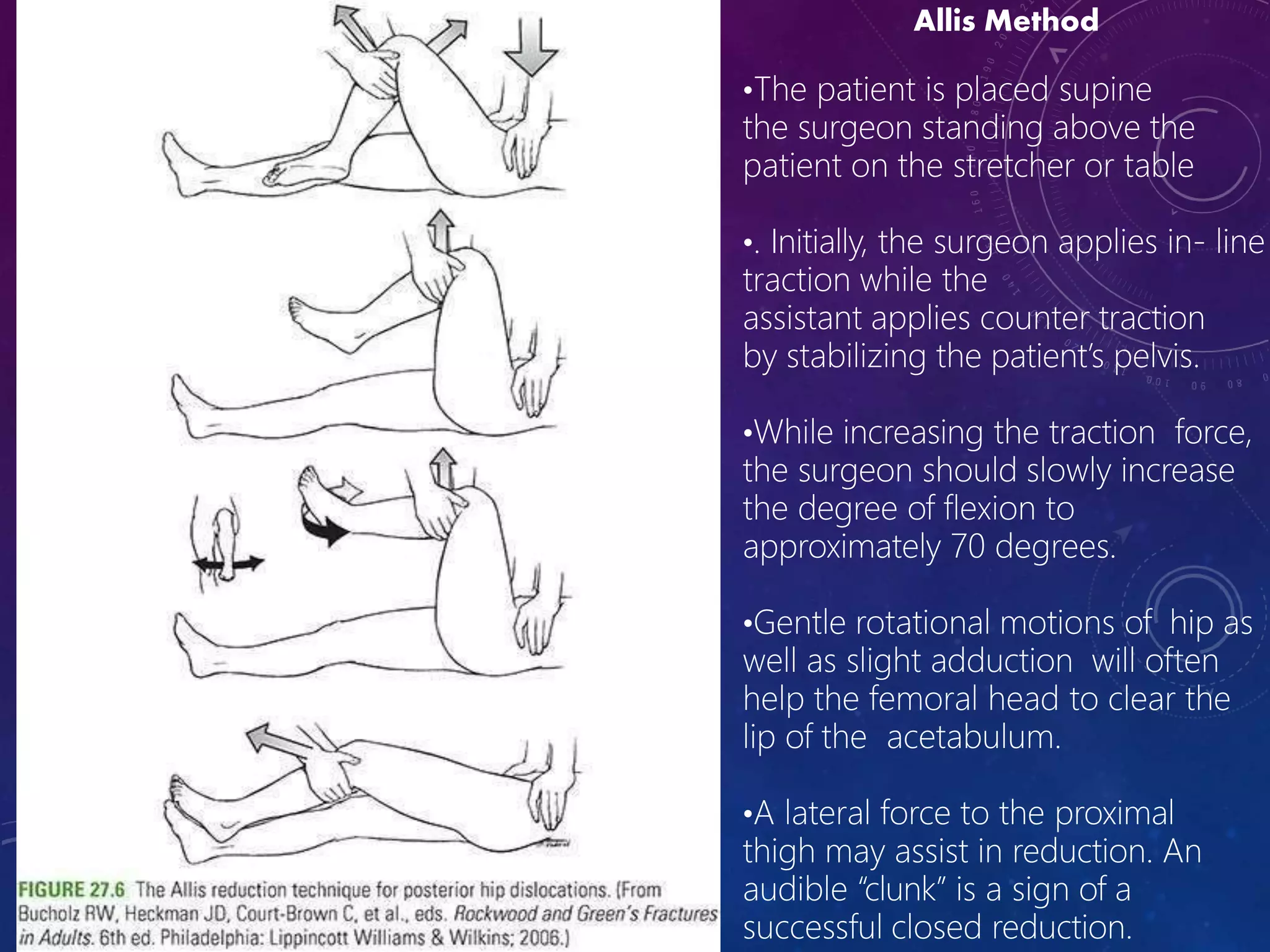 Hip Dislocation PPT FINAL.pptx