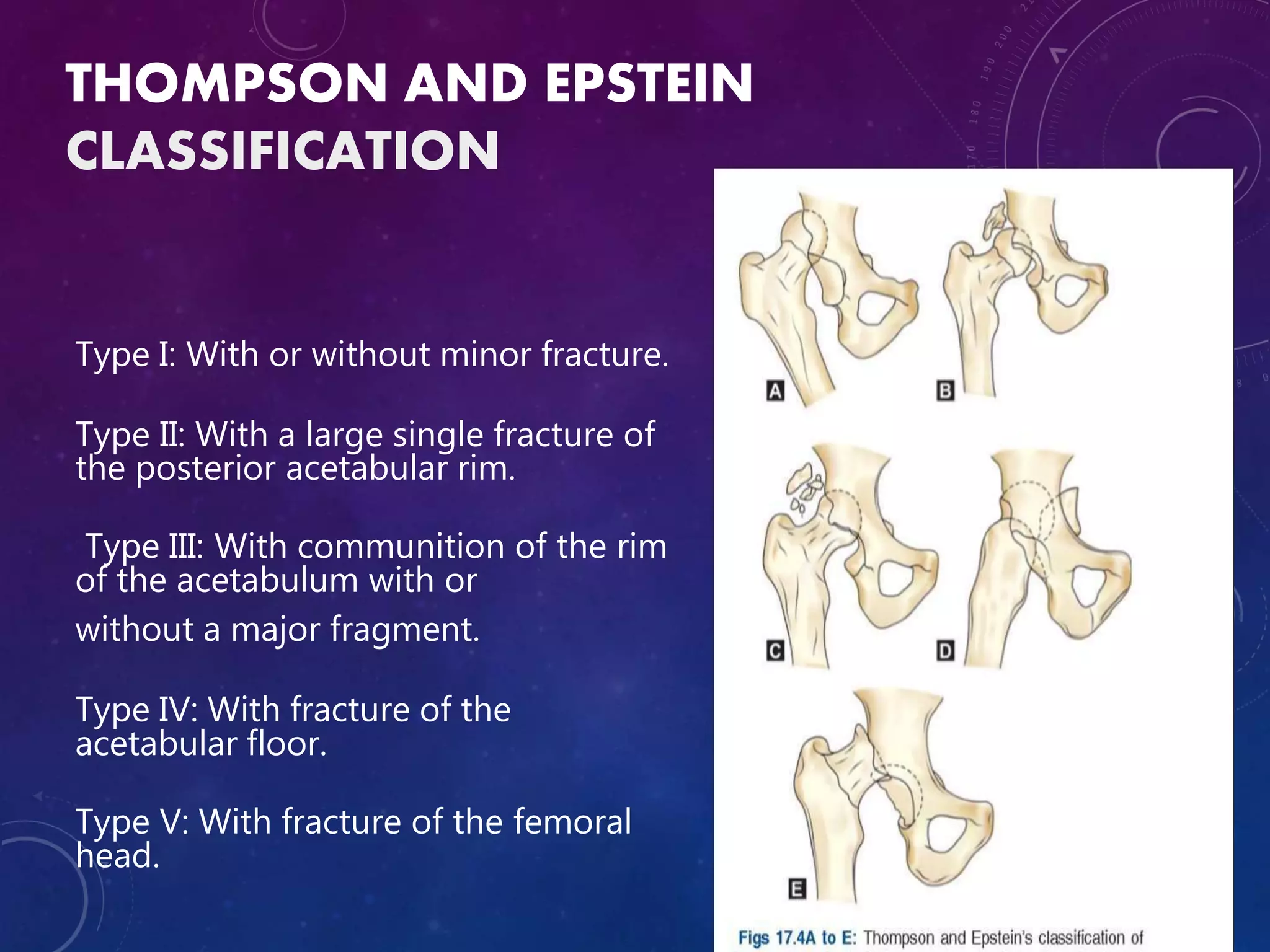 Hip Dislocation PPT FINAL.pptx