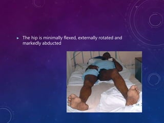 Hip Dislocation PPT FINAL.pptx