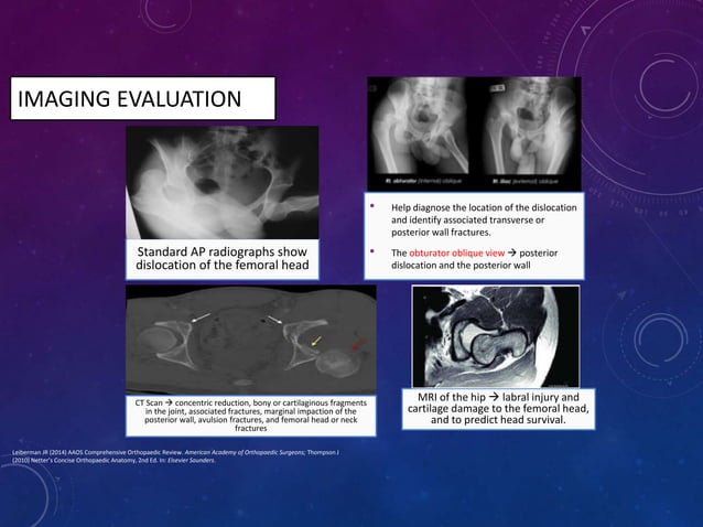 Hip Dislocation PPT FINAL.pptx