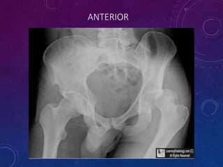 Hip Dislocation PPT FINAL.pptx
