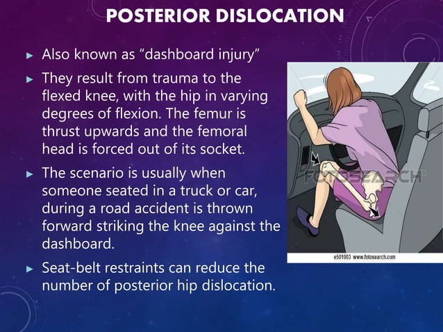 Hip Dislocation PPT FINAL.pptx