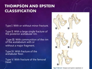 Hip Dislocation PPT FINAL.pptx