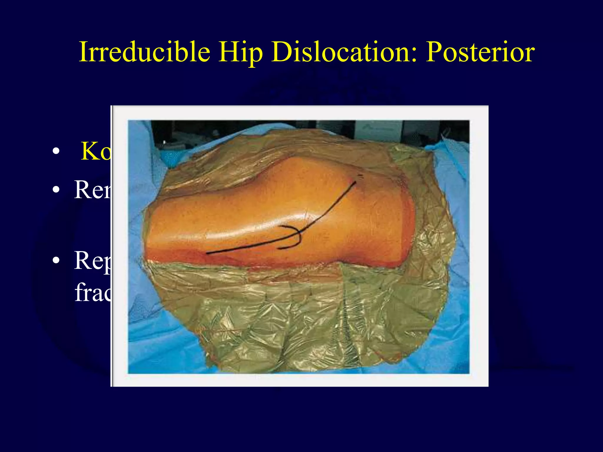 Hip dislocations and femoral head fractures | PPT