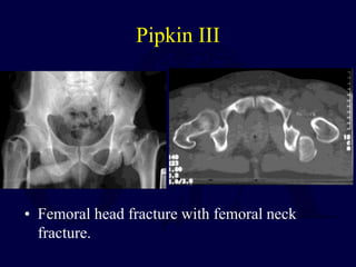 Hip dislocations and femoral head fractures | PPT