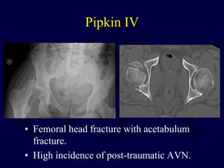 Hip dislocations and femoral head fractures | PPT
