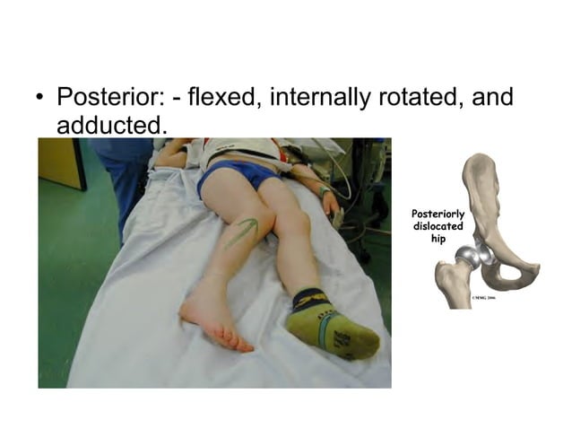 Hip Dislocation Management | PPT