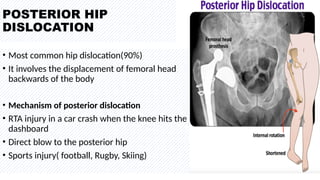 HIP DISLOCATION , MECHANISM AND MANAGEMENT.pptx