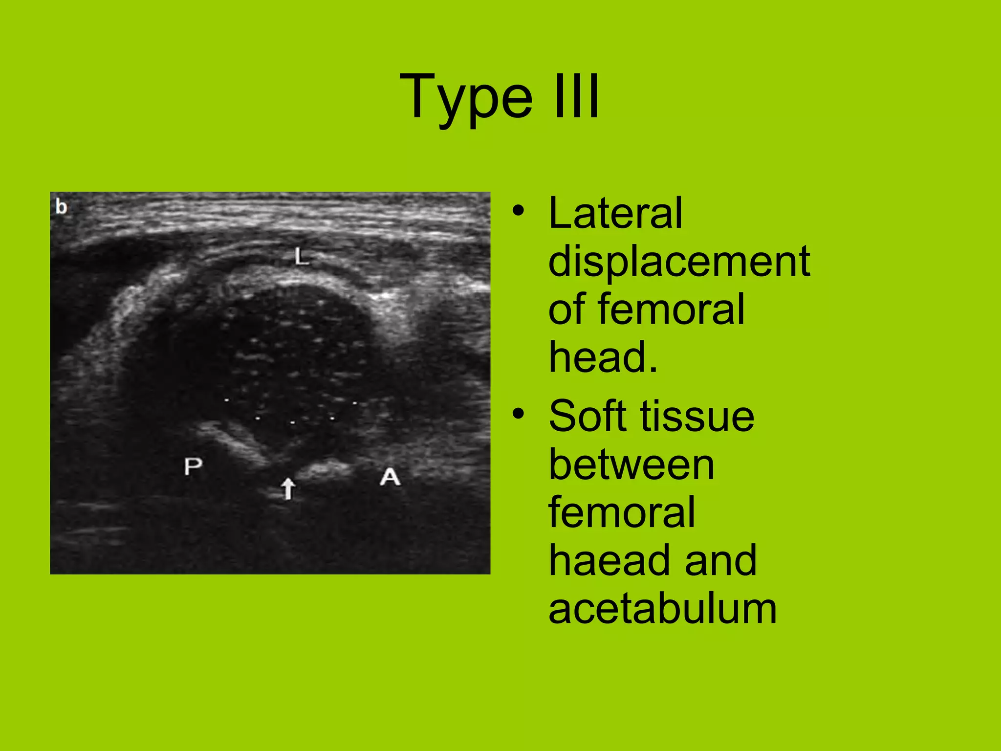 Hip dysplasia imaging . | PPT