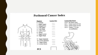 Hipec for metastatic colorectal cancers | PPTX