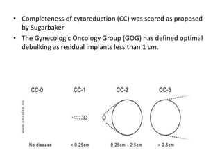 HIPEC with CRS in ADVANCED CARCINOMA OVARY | PPTX