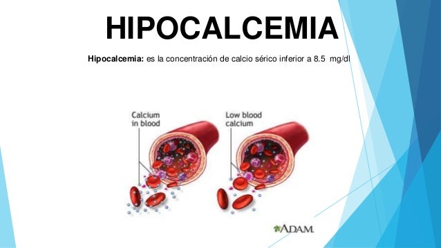 Hipocalcemia