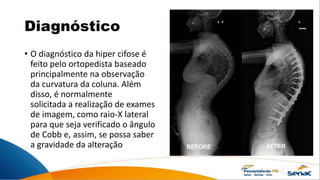 hipercifose.pptx | Physical Therapy | Wellness