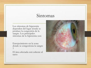 Hiperemia | PPTX