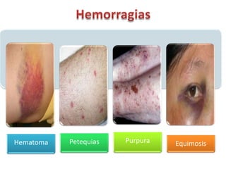 Hiperemia y congestión | PPTX