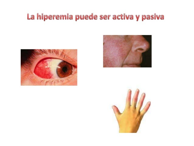 Hiperemia y congestión